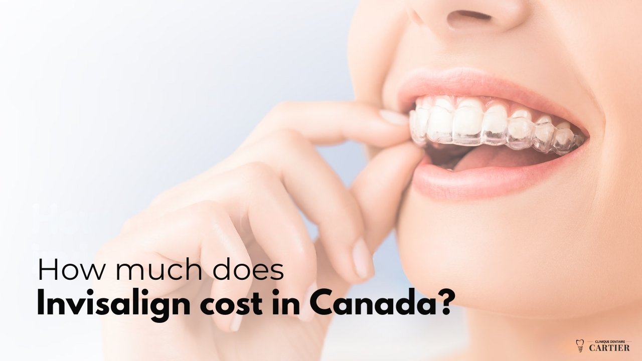 How Much is Invisalign in Canada? Invisalign Cost Canada