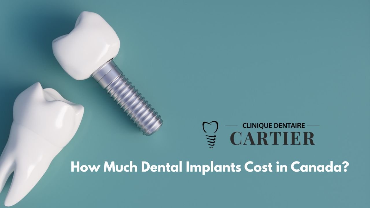 How Much Dental Implants Cost in Canada: 2025 Guide